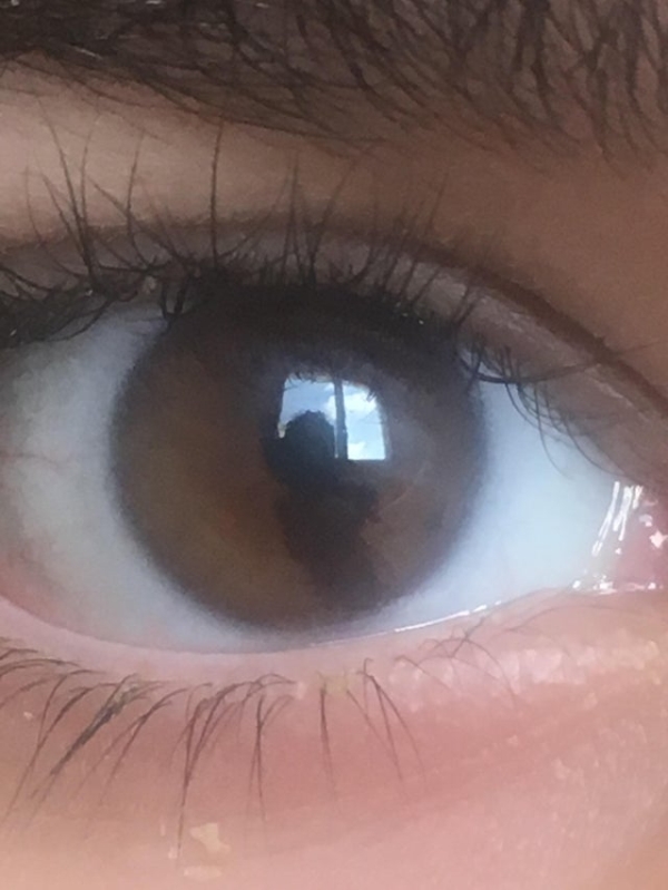 Cool Genetic Anomalies That Make People Stand Out