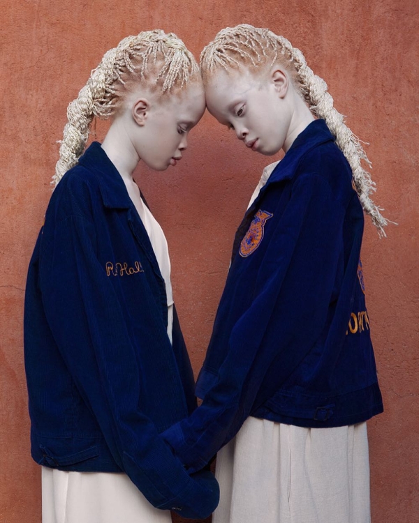 Cool Genetic Anomalies That Make People Stand Out