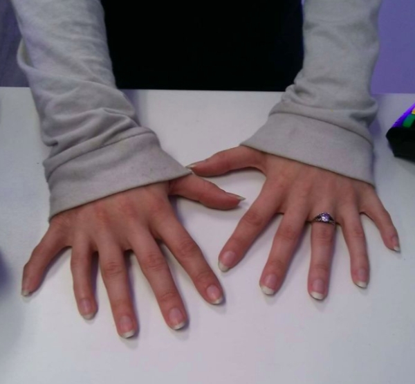 These people’s genetic anomalies will blow your mind (30 Photos)