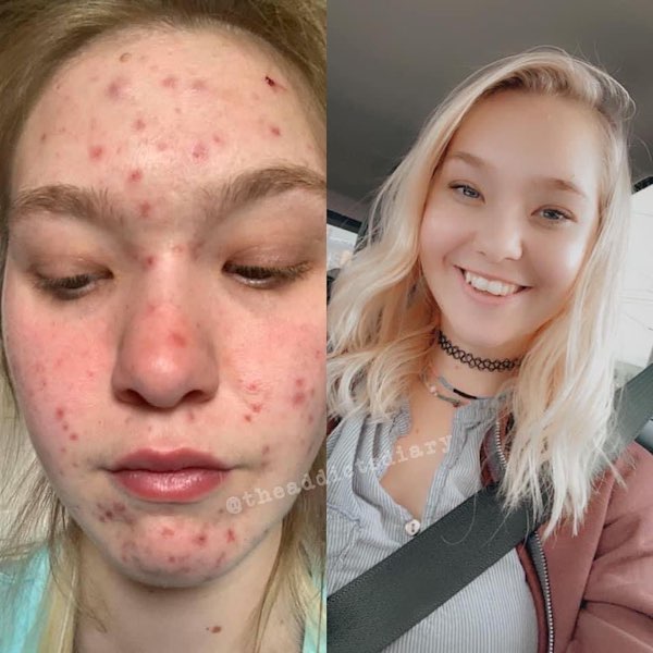 Inspiring Transformations Of Drug Addicts Before And After Addiction