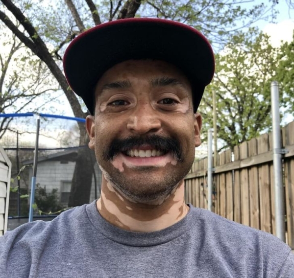 Beautiful body abnormalities that make people even more awesome