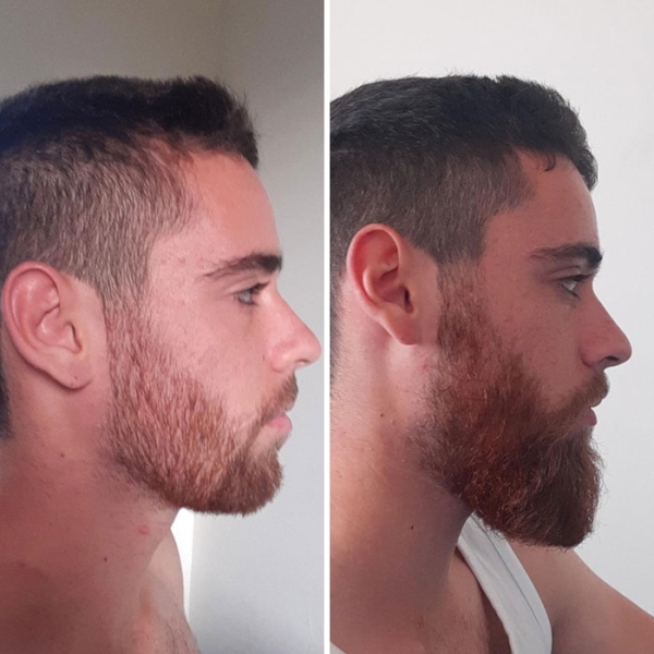 INSANE before and after beard transformations (32 Photos)