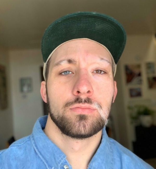 These people’s genetic anomalies will blow your mind (30 Photos)