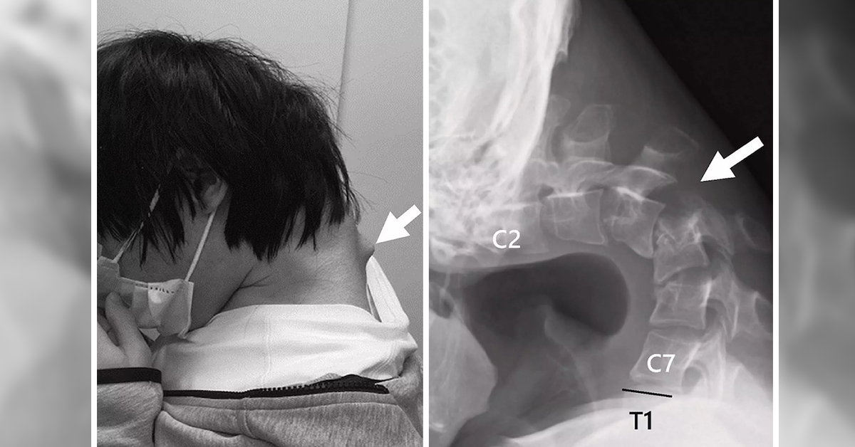25-Year-Old Develops Severe Neck Bend From Staring at His Phone